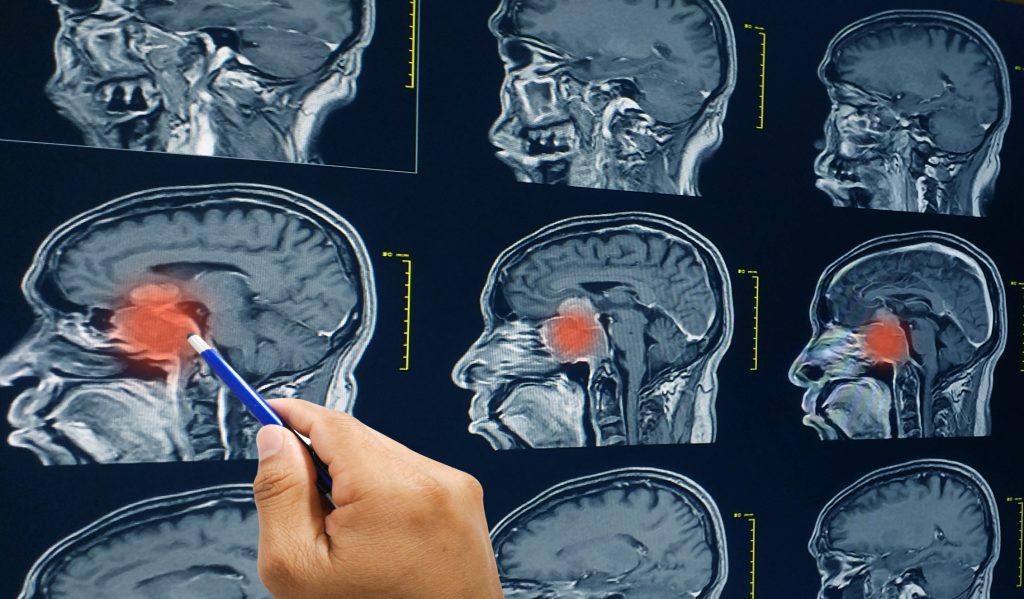 Brain Imaging to Detect Marijuana Intoxication — Columbus OVI/DUI ...